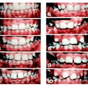 Index of Orthodontic Treatment Need (IOTN) explained. - St Michael's ...