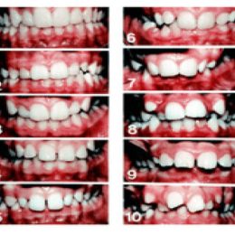 Index of Orthodontic Treatment Need (IOTN) explained. - St Michael's ...